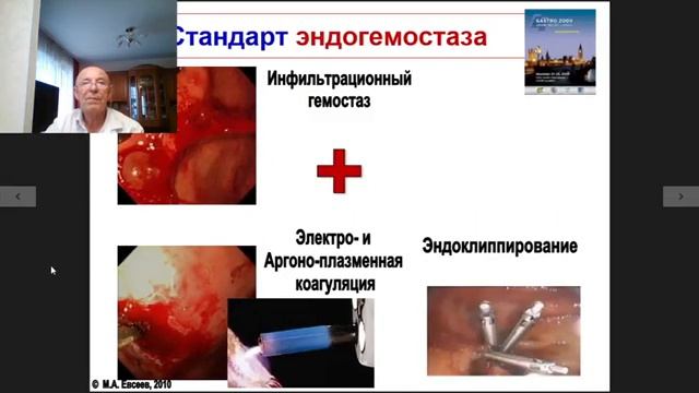 Консервативный или оперативный гемостаз при ЖКК.mp4