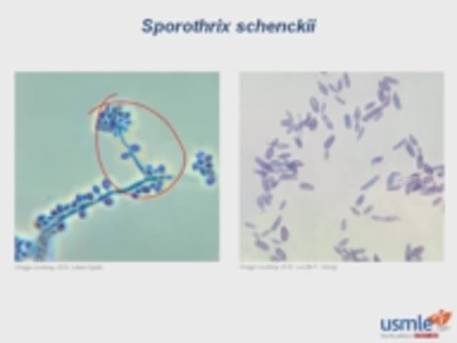USMLE RX - 7.Микробиология - 4.Микология - 3.Sporothrix Schenckii  (*Споротрихоз)