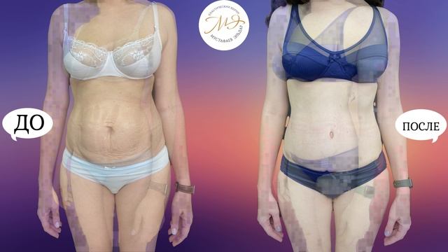 Абдоминопластика с ушиванием диастаза