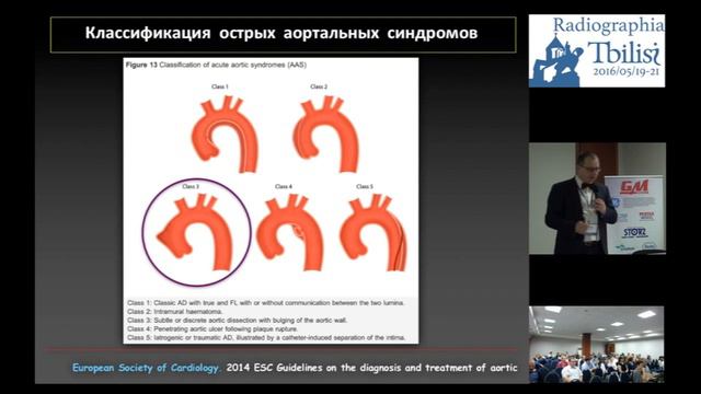 Острый аортальный синдром - тип A по Stanford МДКТ восходящей аорты. Лучевая диагностика
