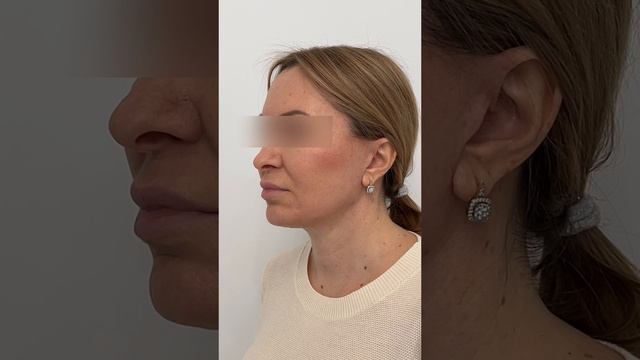 Подтяжка нижней ⅔ лица и шеи, липосакция шеи, платизмопластика, лазерное омоложение кожи лица