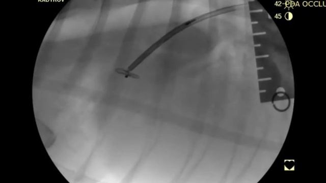 Эндоваскулярное закрытие открытого артериального протока у собаки (ОАП) с помощью окклюдера