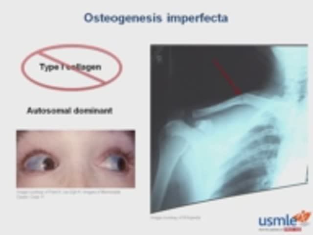 USMLE RX - 1.Биохимия - 1.Клеточная - 11.Несовершенный остеогенез