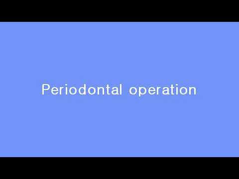 Применение пьезоаппарата SS600L в периодонтологии