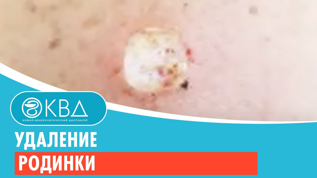 Удаление родинки. Клинический случай №89