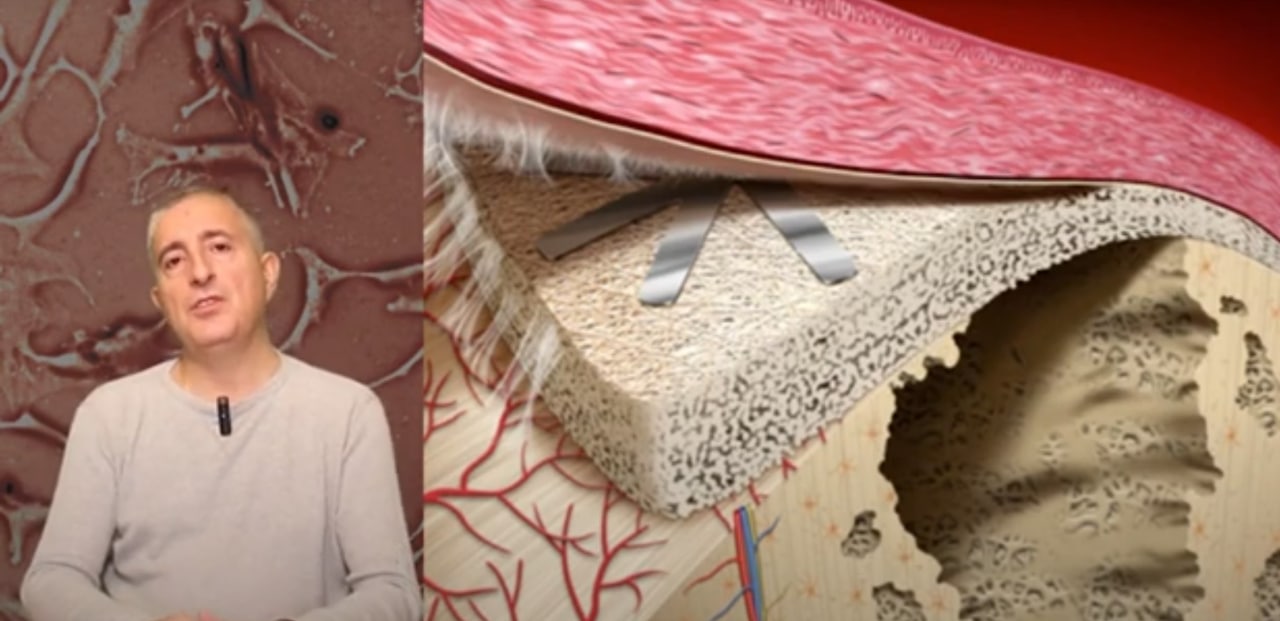 Направленная Костная Регенерация (НКР) Часть 1. Мембраны