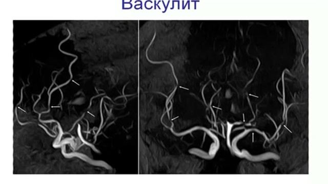 Интракраниальные опухоли, рассеянный склероз и другие поражения белого вещества головного мозга