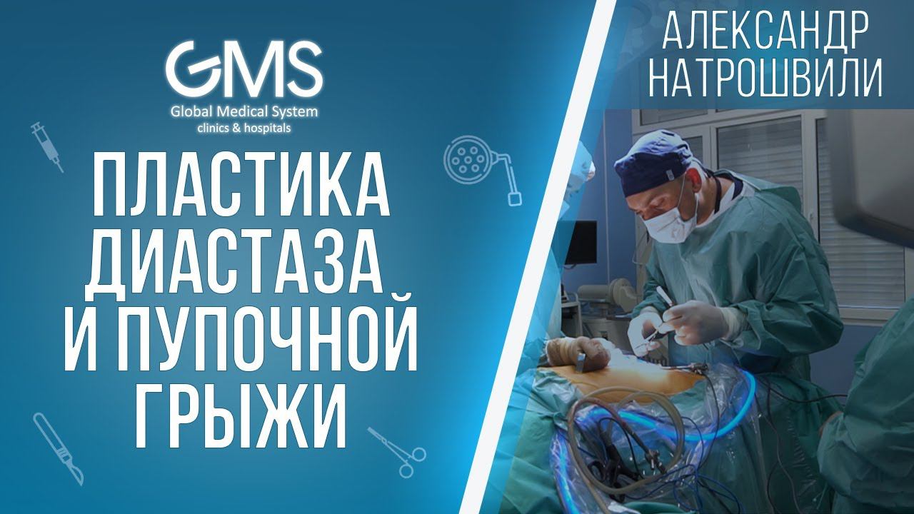 Эндоскопическая пластика диастаза и пупочной грыжи (SCOLA)