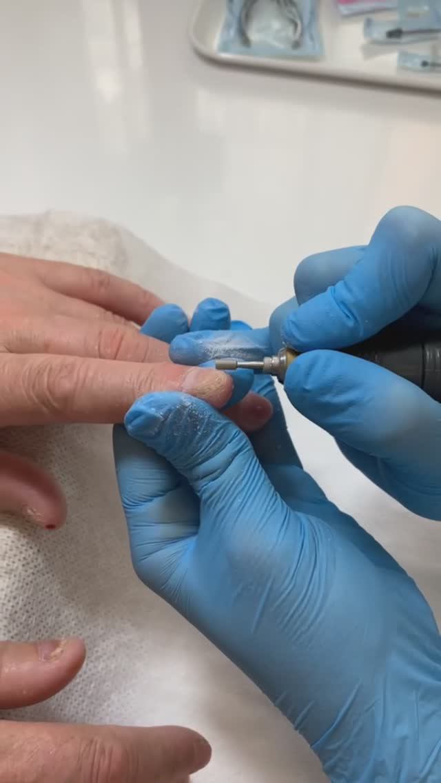 Грибок ногтей, обработка