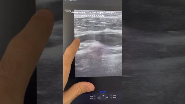 Атеросклероз. Узи сонных артерий. Лечение холестерина. Лечение атеросклероза