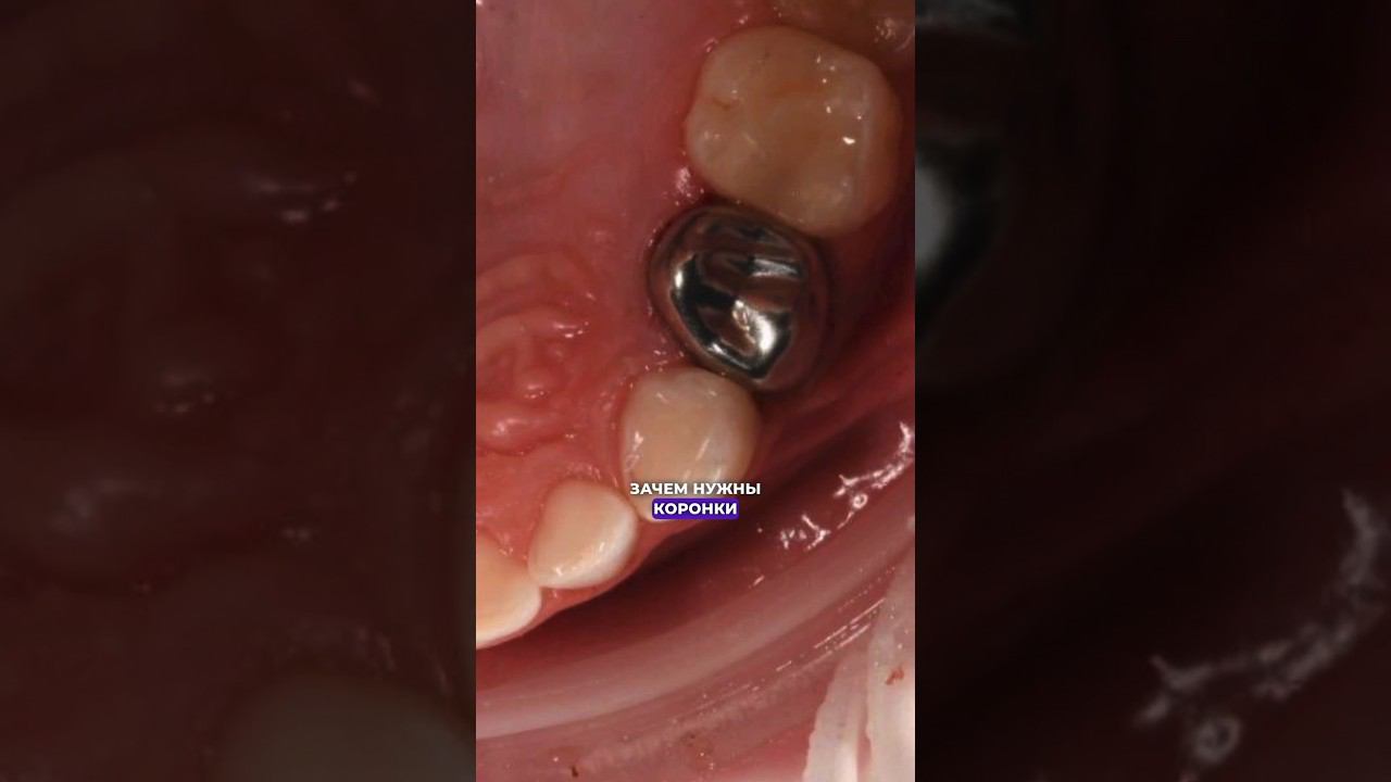 Зачем нужны коронки на молочные зубы? #shorts ❤️ “СТОЛИЦА”  Москва, ЦАО. Круглосуточно!