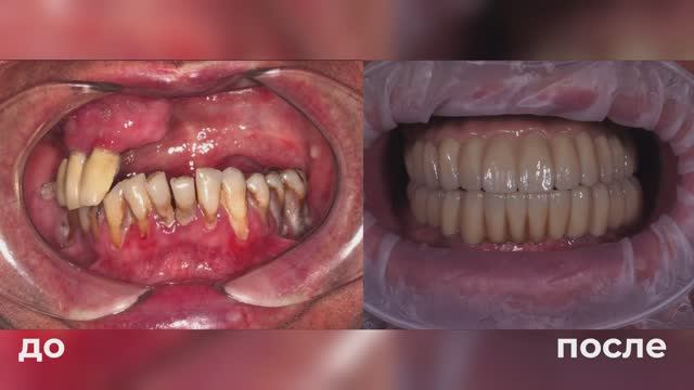 Восстановление верхней левой челюсти