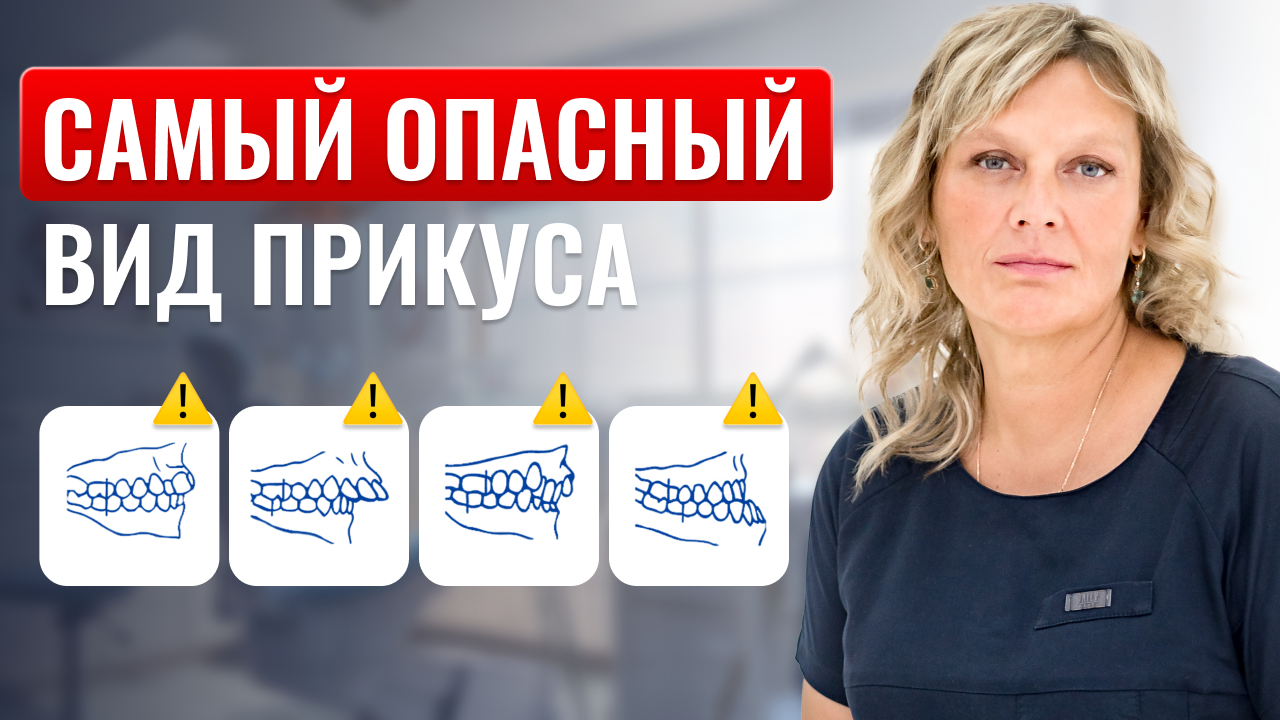 Виды прикусов. Как определить, есть ли у вас проблемы с прикусом?
