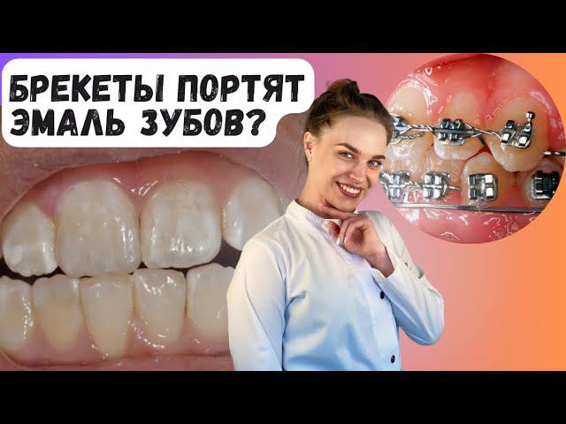 ШОК! Брекеты портят эмаль зубов #стоматологиятюмень #брекетыпортятэмаль #брекетыуход #ортодонттюмень