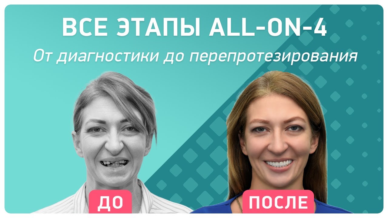 Имплантация all-on-4: все этапы лечения в одном видео
