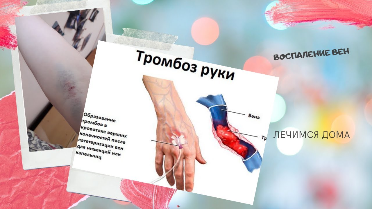 Лечим вены  самостоятельно.mp4