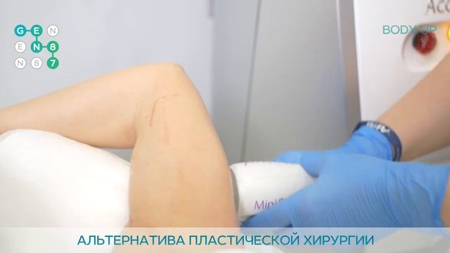 БЕЗОПЕРАЦИОННАЯ ЛИПОСАКЦИЯ BODY UP на аппарате ACCENT Сеть клиник косметологии GEN87