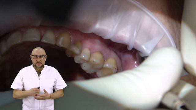 Удаление зуба при остеопоротическом лечении