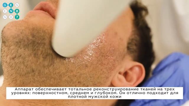 БЕЗОПЕРАЦИОННАЯ ПОДТЯЖКА И ОМОЛОЖЕНИЕ ЛИЦА МУЖСКАЯ КОСМЕТОЛОГИЯ Сеть клиник косметологии GEN87