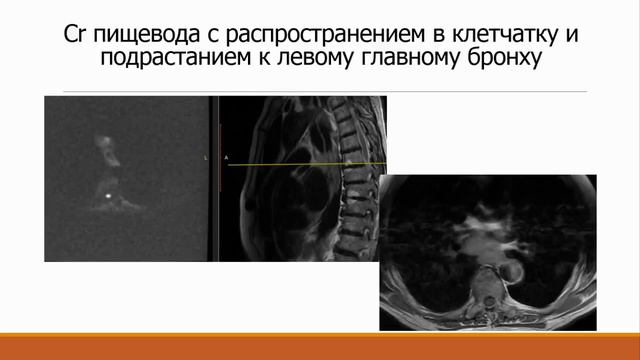 МРТ в диагностике заболеваний органов средостения