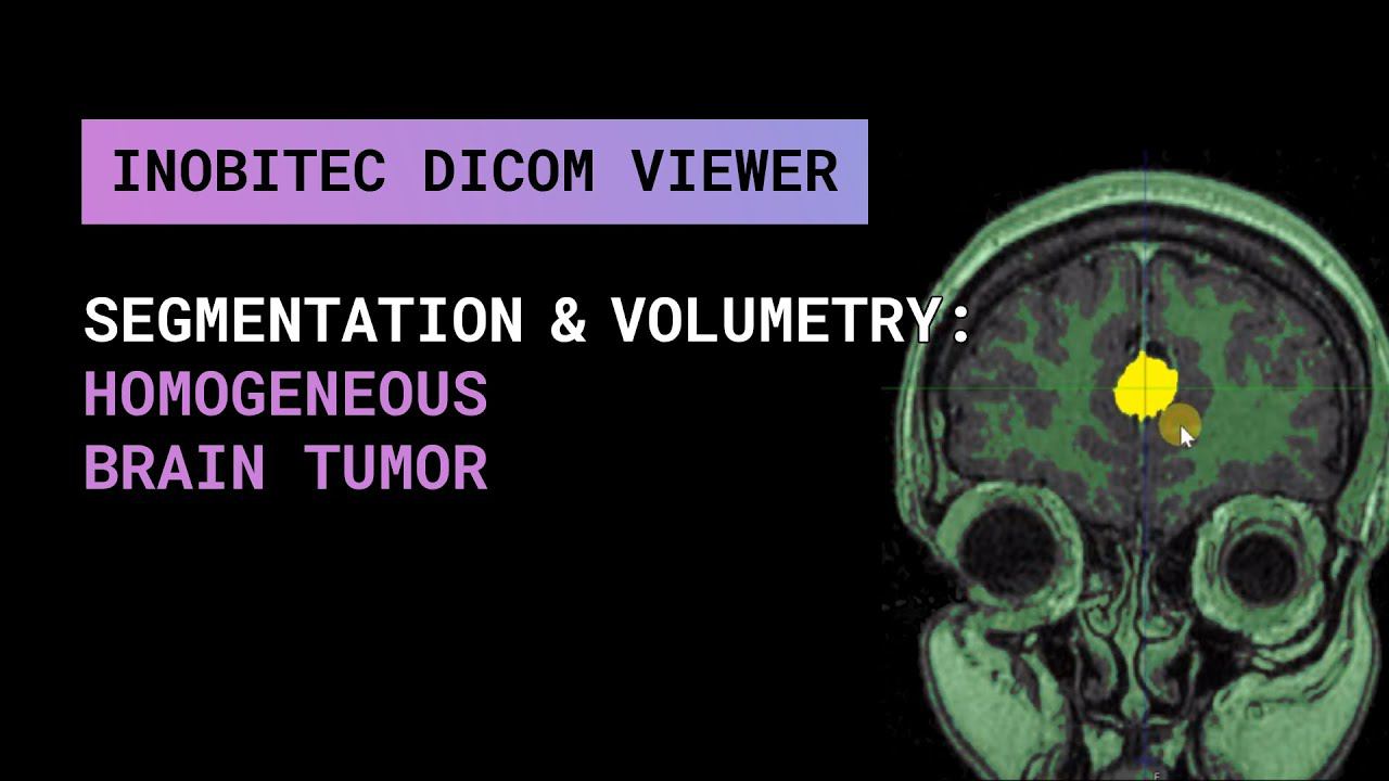 Сегментация и 3D-представление: однородная опухоль мозга