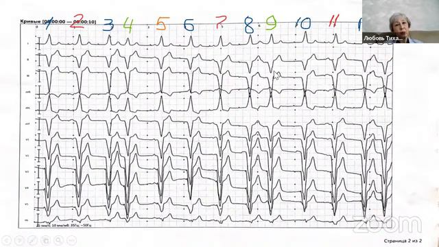 Основные трудности и ошибки при интерпретации ЭКГ у пациентов с ЭКС