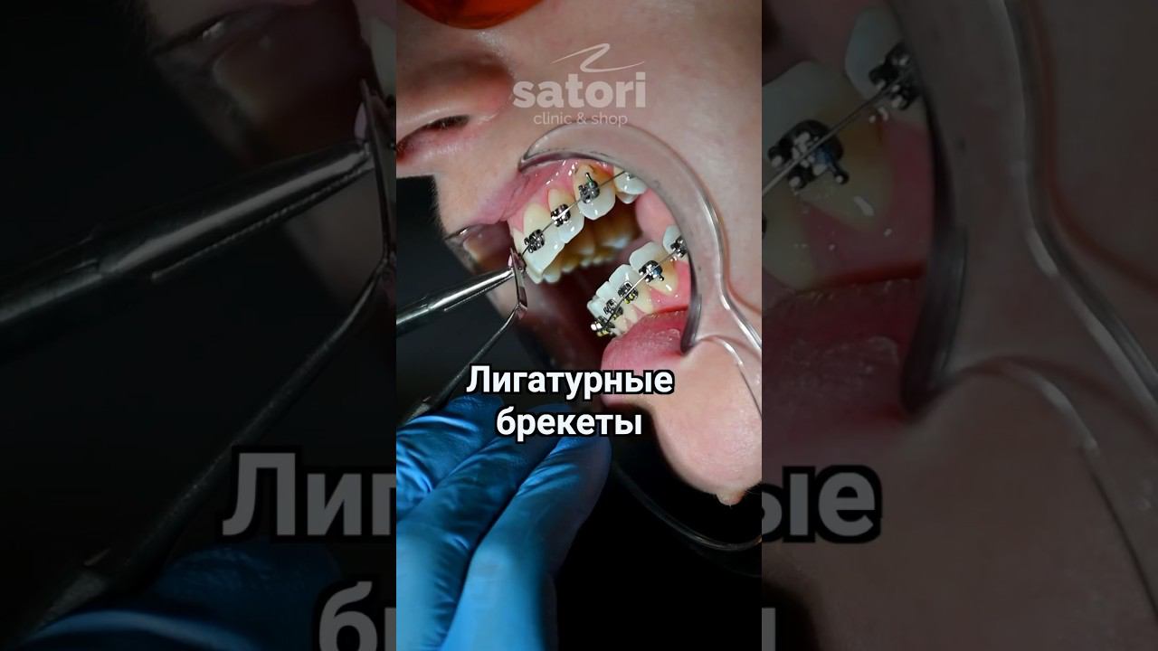 Лигатурные брекеты #зубы #брекеты #braces