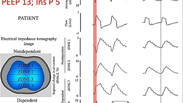 Самоповреждение легких при ИВЛ Горячев А.С.