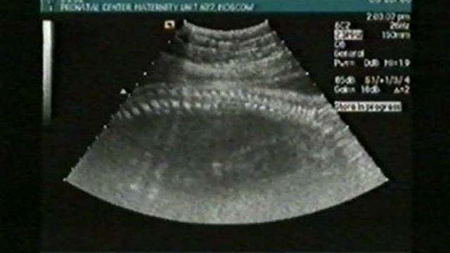 Диагностика пренатальных заболеваний.