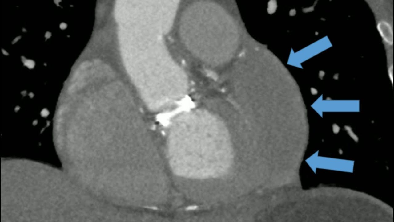 Торакоскопическая санация перикарда