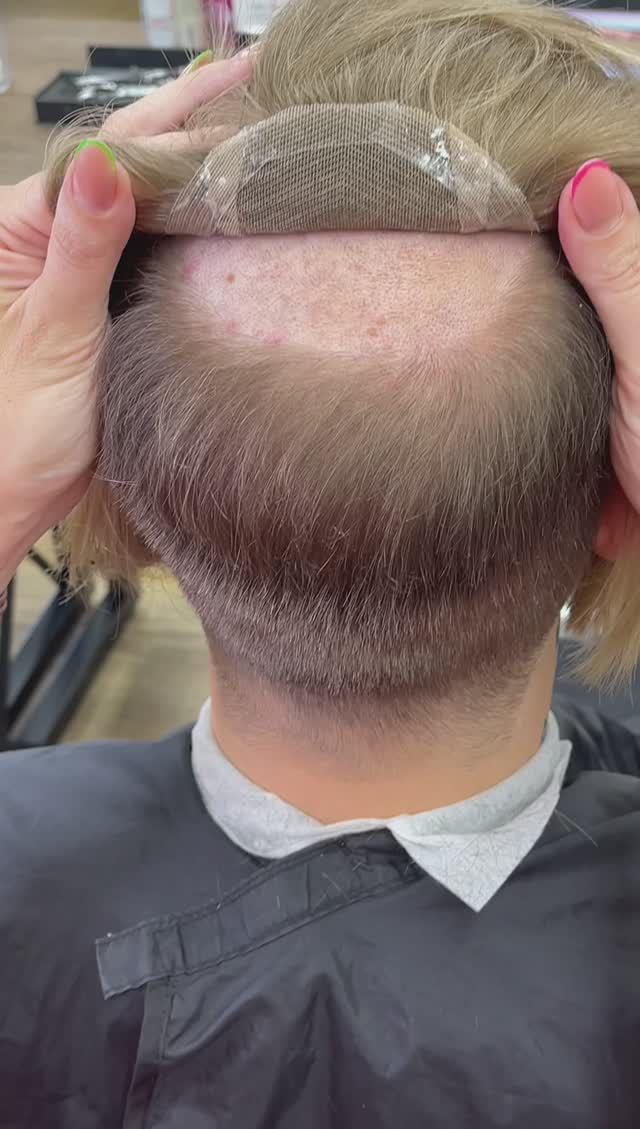 Мужская накладка. Мужская алопеция. Установка мужской системы замещения волос