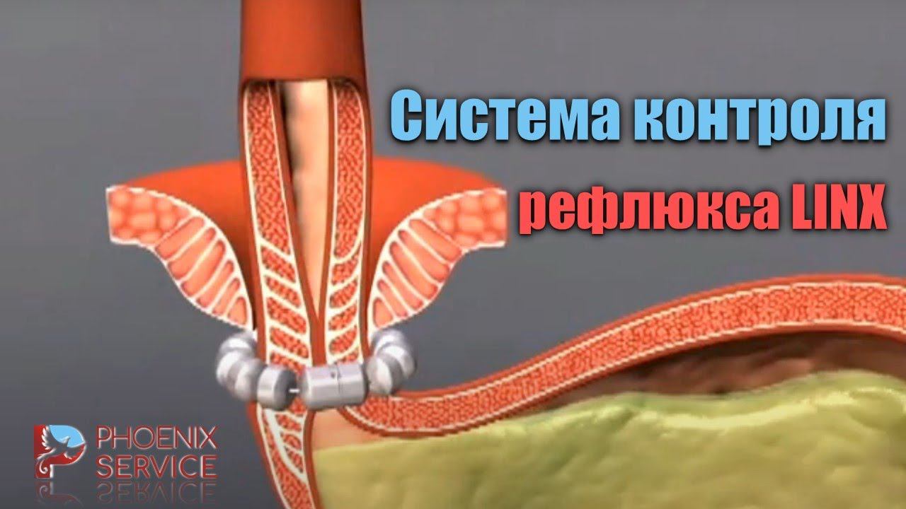 Система контроля рефлюкса LINX