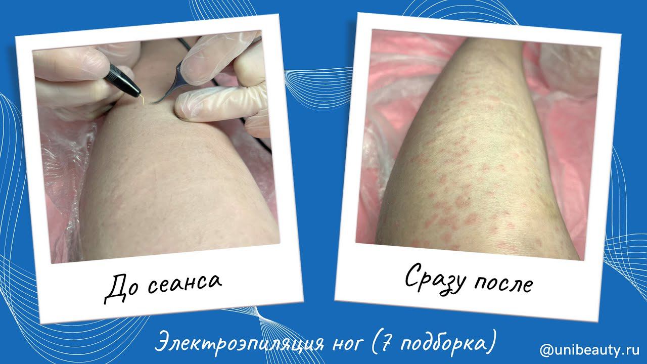 Электроэпиляция ног методом blend