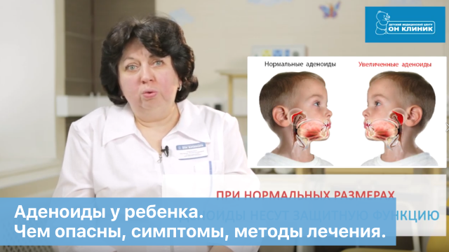 Аденоиды у ребенка. Чем опасны, симптомы, методы лечения.