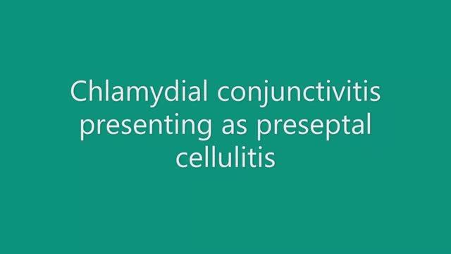 ЖК офтальмохламидиоз .mp4