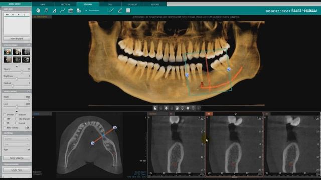 Установка импланта