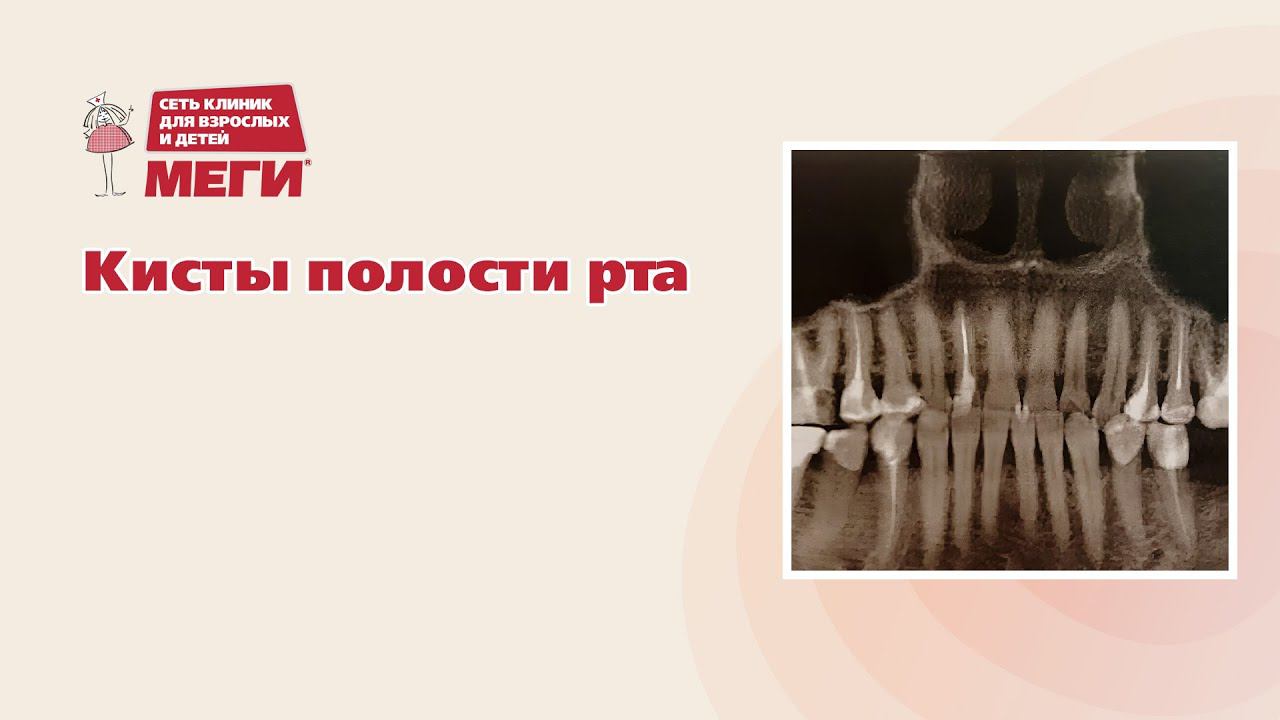 Что делать с кистой в челюсти?