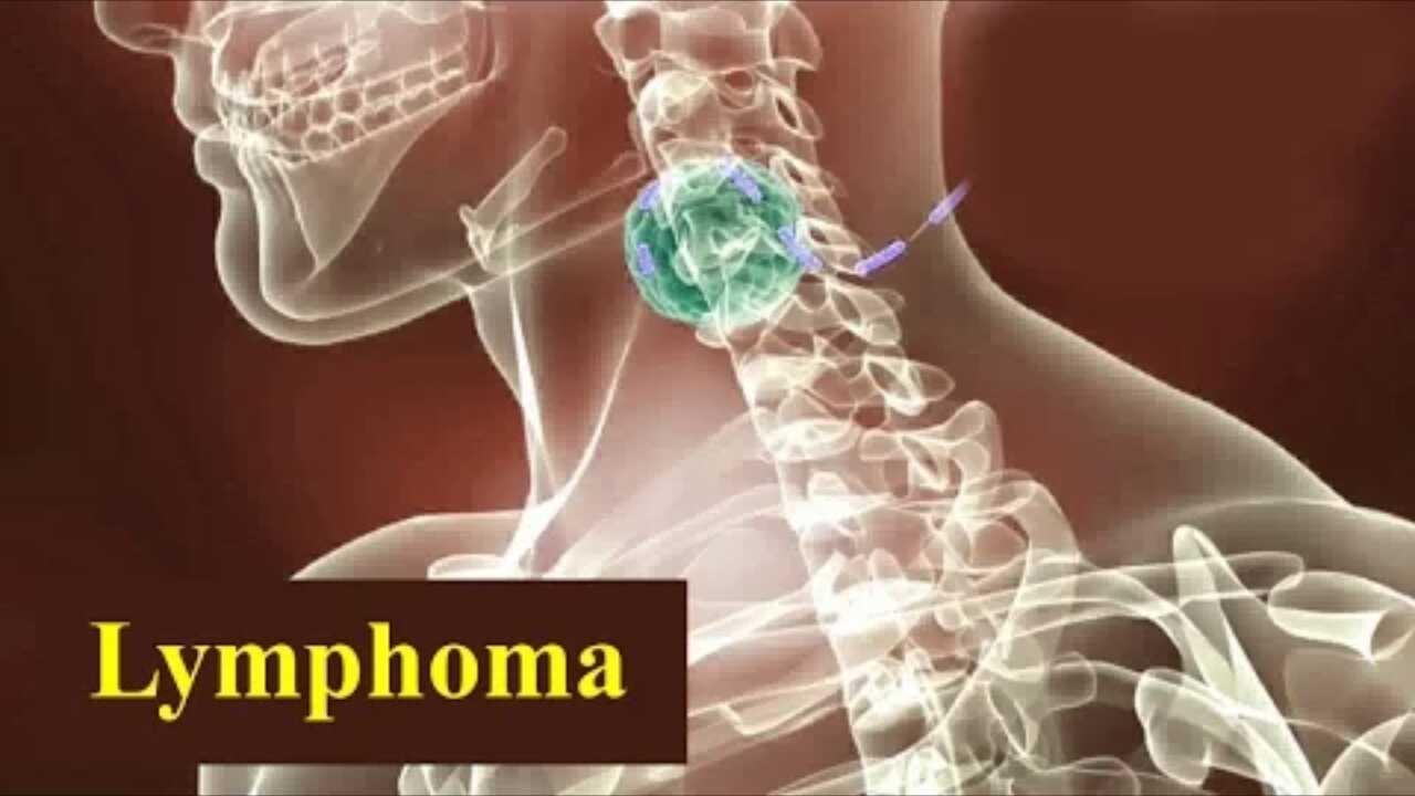 Сказка для взрослых: Лимфома