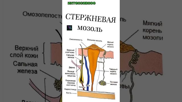 Стержневая мозоль . Причины.