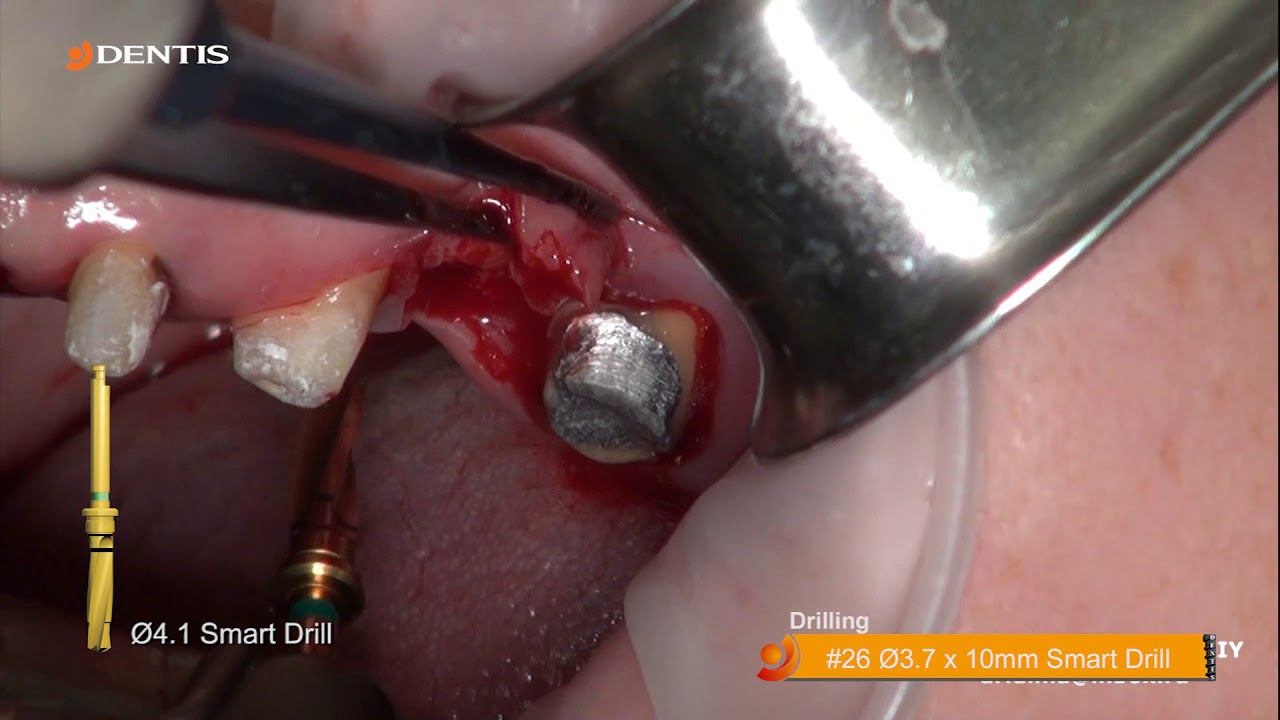 Др. Шумовский Д.Б. Имплантация в области 26 зуба. s-Clean от Dentis