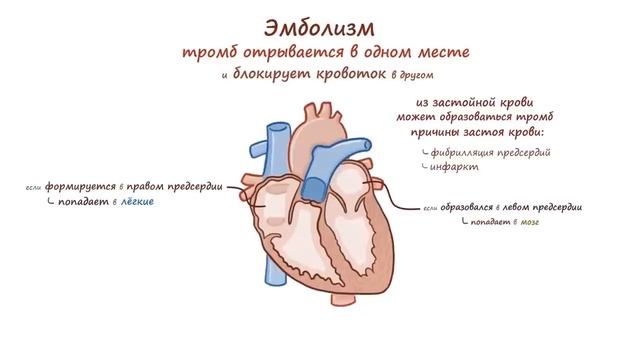 Инсульт - причины, симптомы, лечение (неврология лекция)