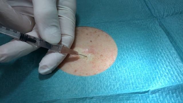 ?️  Удаление атеромы  Местная анестезия.mp4