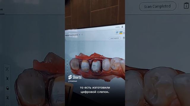 Протезирование зубов со сканером - ДО_ПОСЛЕ #протезирование  #протезированиезубов
