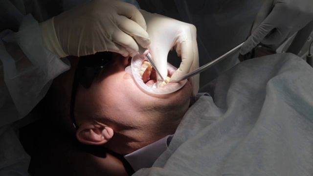 Отзыв пациента после имплантации методом "Все на 4" Наша стоматология СПб