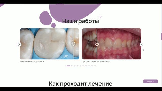 Наши работы: сайт для Dentaplan кариес