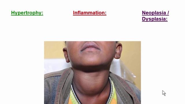 USMLE RX - 3.Эндокринная система - 3.Патология - 4.Причины возникновения зоба