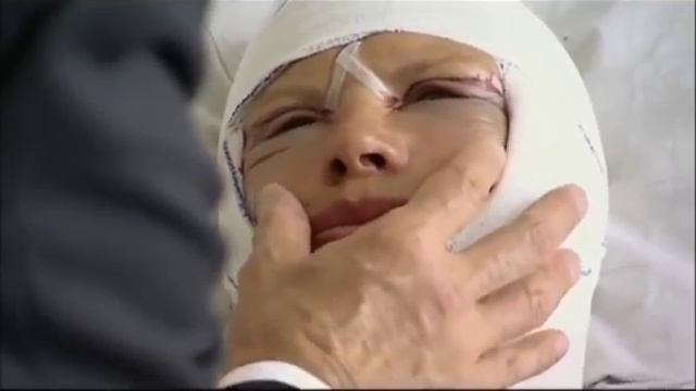 Мини-лифтинг лица в Европе, в парижской клинике