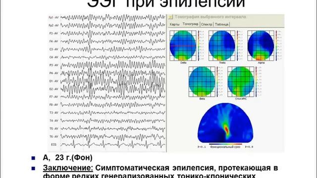 Нейрофизиологические методы исследований в неврологии.mp4