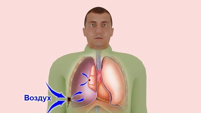 Травма груди, первая помощь. Основные проявления травмы груди.