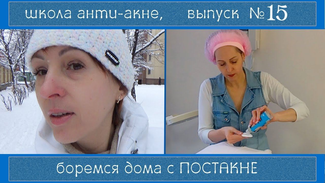 ШЛИФОВКА лица в домашних условиях | ПЯТНА от прыщей | ПОСТАКНЕ | Морщины | IHERB КИСЛОТЫ +